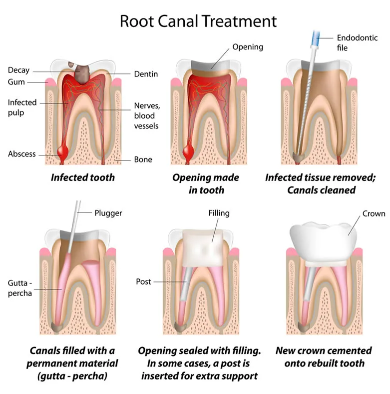 Root Canals in Sunrise - Trusted Sunrise Endodontist